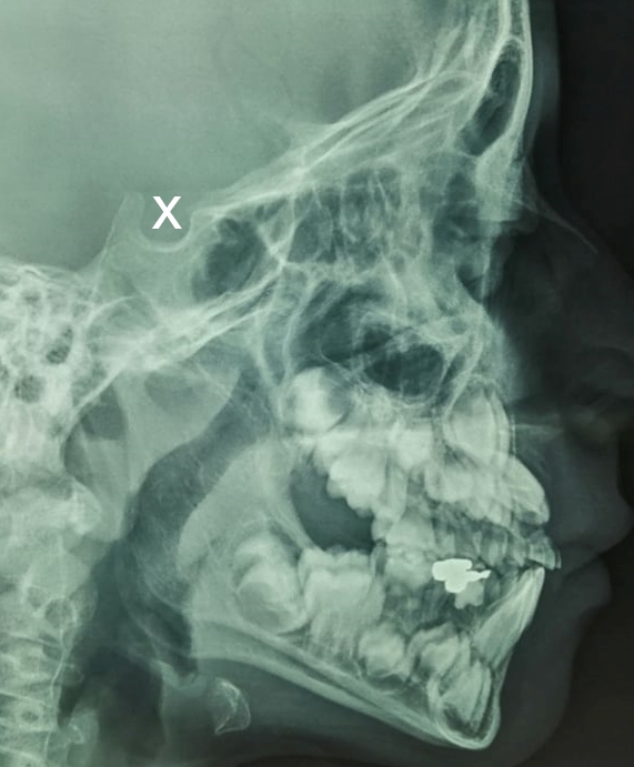 LA SILLA TURCA – carlosorellanaayala